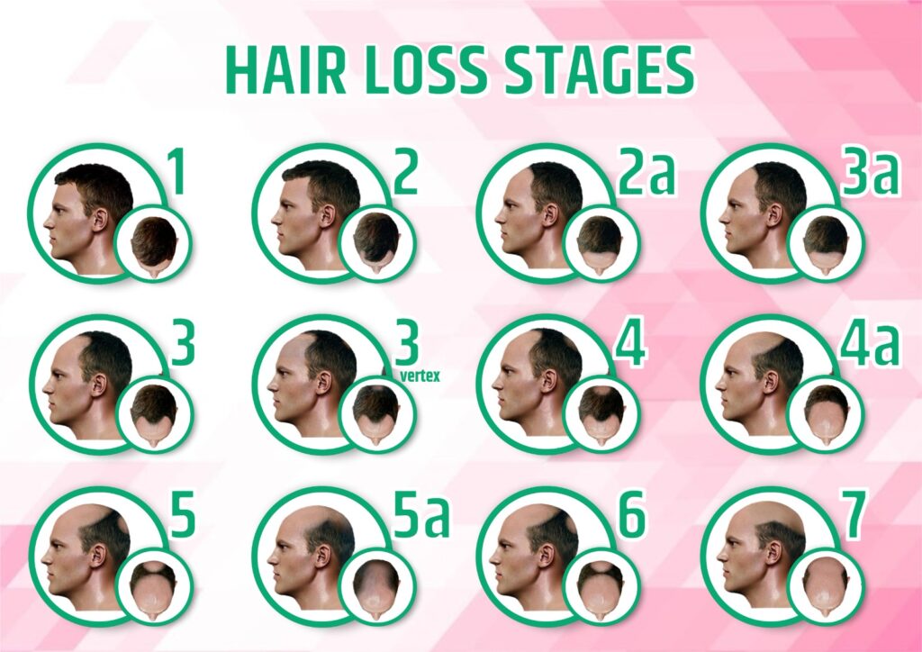 Stages of Hair Loss - GenNext Pharma
