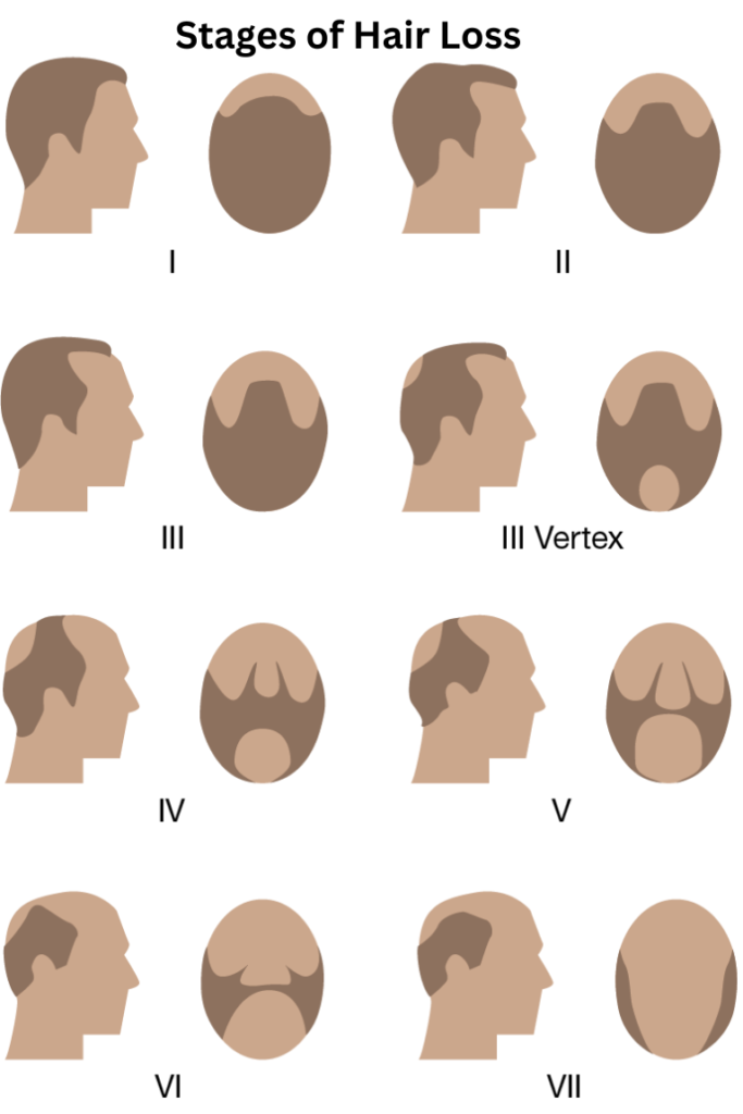 Stages of Hair Loss - GenNext Pharma
