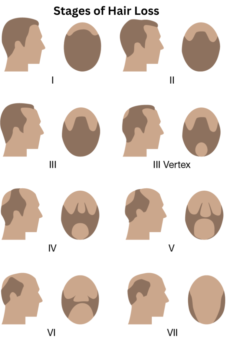 Stages of Hair Loss - GenNext Pharma